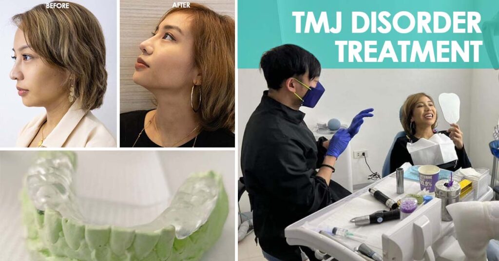 Treating TMJ Disorder: What it’s like to get a jaw Botox and TMJ splint ...