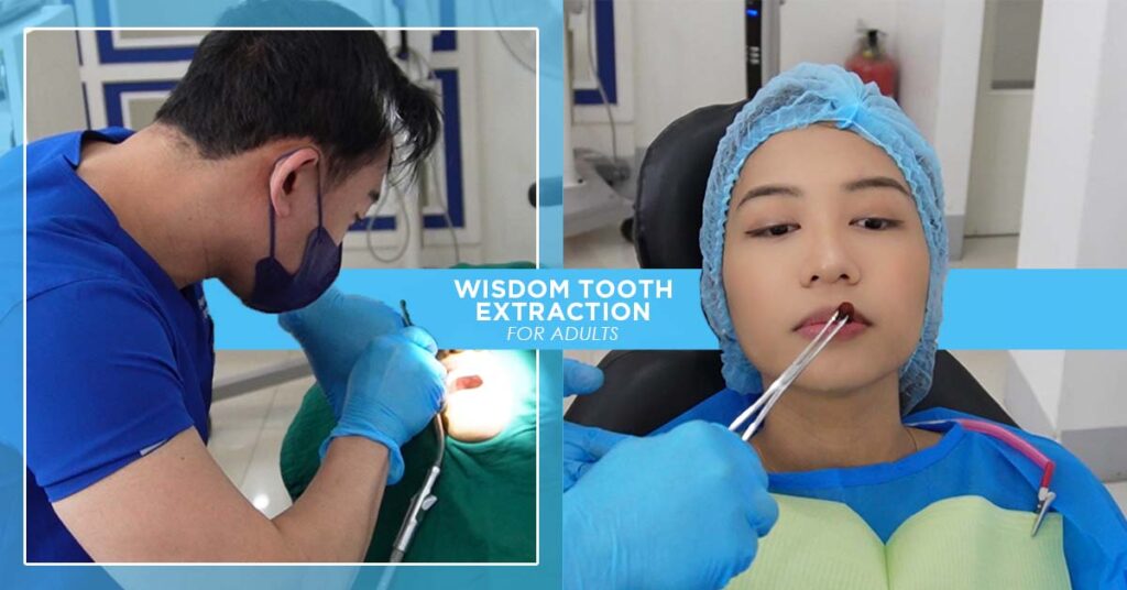 What it’s like to have your wisdom teeth removed in your late 20’s – Manila Millennial